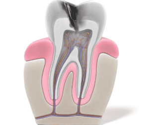 Non-Surgical Root Canal - Charlotte, Ballantyne | Premier Dentistry ...
